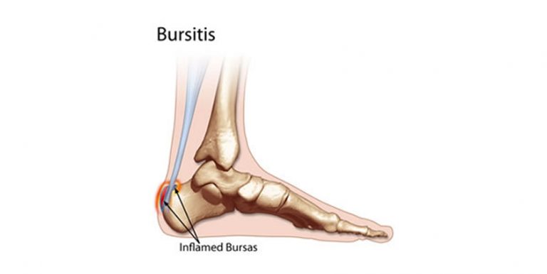 Retrocalcanel Bursitis – 4 Life Podiatry