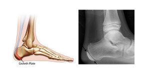 Sever’s Disease – 4 Life Podiatry